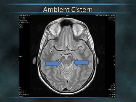 Brain Cisterns Dr Yaser Abdulghani Al Qasimi Mbbs