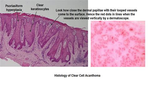 Dermoscopy Made Simple Clear Cell Acanthoma