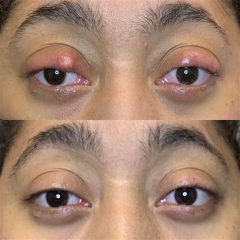 Procedures Joli Oculoplastics