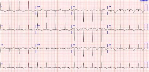 Dr Smith S ECG Blog