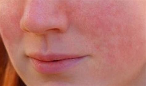 Stress Rash Pictures ~ Medical Pictures And Images