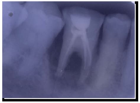 Root Canal Therapy Performed In 46 Showing Calcified Canals