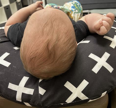 Understanding Cvai And Ci Numbers For Infant Head Shape A Guide To
