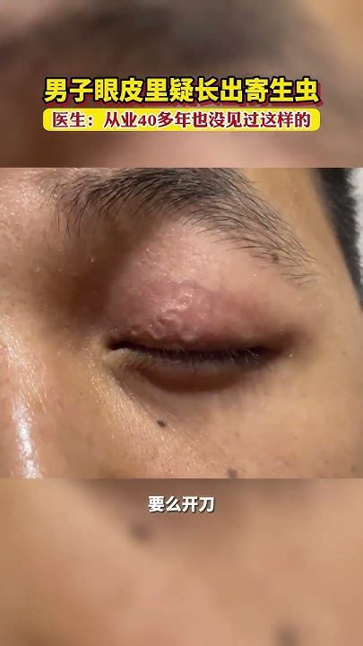 2月23日，河南郑州一男子眼皮内疑长出寄生虫，跑各大医院治疗无奈医生们都束手无策 Youtube