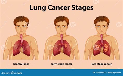 Stages Of Lung Abscess Cartoon Vector 137679509