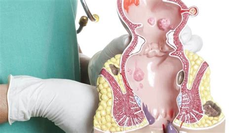 Atasi Wasir Dengan Teknologi Terkini Di Klinik Vena Wasir Center