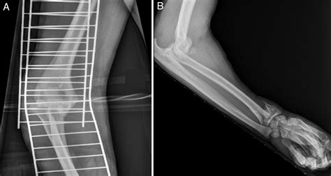Elbow Dislocation With Ipsilateral Fracture Of The Distal Radius Associated With A Brachial