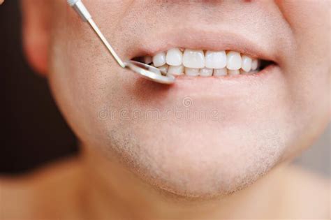 Close Up Examination Of Teeth With Veneers With A Special Dental