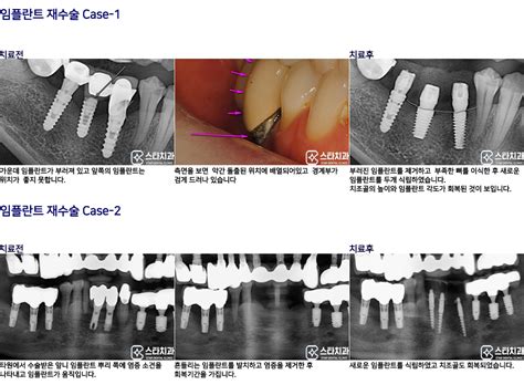 창원 마산 합성동 임플란트 재수술 창원 스타치과