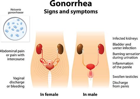 30 Gonorrhea Stock Illustrations Royalty Free Vector Graphics And Clip
