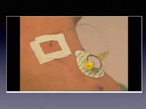 Shoulder Block Tutorial 2014 Ppt