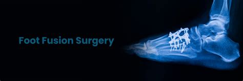 Foot Fusion Surgery Recovery Tips And Expectations