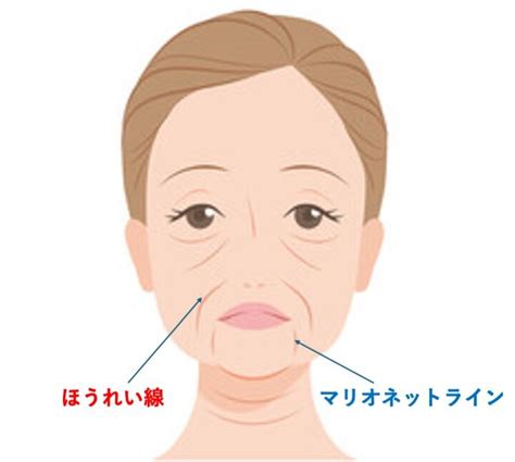 ほうれい線とマリオネットラインの違いは？原因や治療法を徹底比較