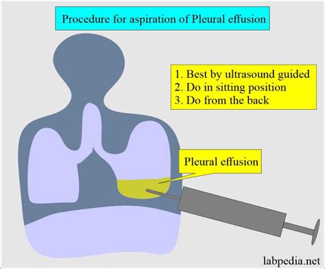 Fluid Analysis Part 6 Pleural Fluid Aspiration Procedure