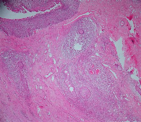 The Polypoid Masses Are Composed Of Normal Looking Urothelium With