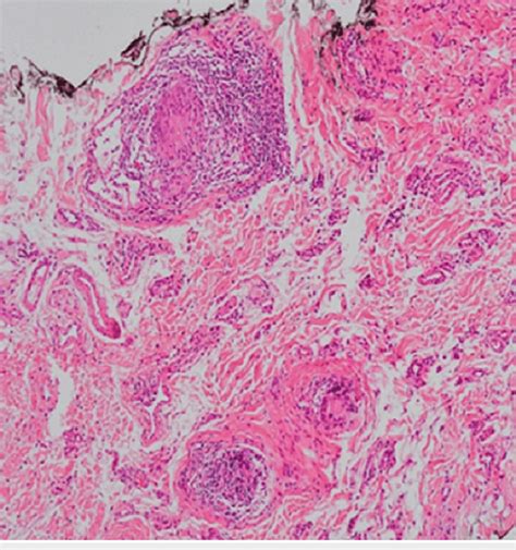 Lymphohistiocytic Nodules Surrounded By Multinucleated Giant Cells