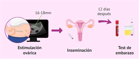 Inseminación Artificial En Una O Ambas Mujeres De La Pareja