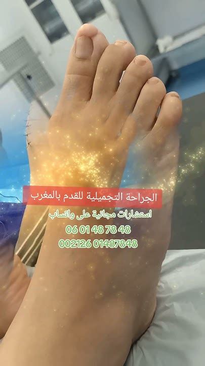 ما هو علاج اعوجاج أصابع القدم؟ قبل و بعد العملية Youtube
