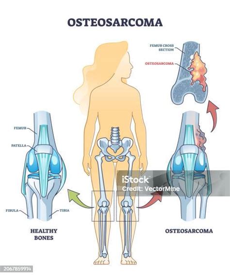 Osteosarcoma Bone Tumor As Osteogenic Sarcoma Skeleton Cancer Outline