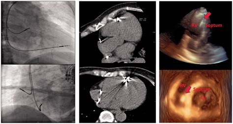 Case With Disagreement Regarding RV Lead Position As Shown By Download Scientific Diagram