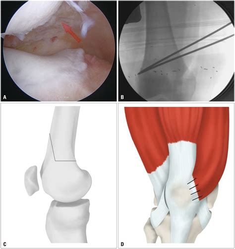 A Combined Closing Wedge Distal Femoral Osteotomy And Medial Reefing