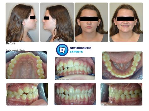 2elastics Top Orthodontist Braces Invisalign