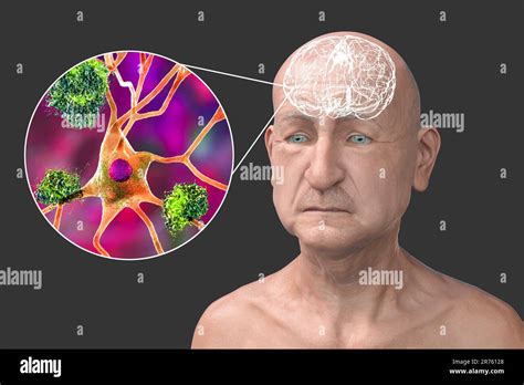 Alzheimers Disease Conceptual Computer Illustration Showing An