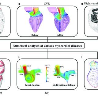 Pdf Application Of Patient Specific Computational Fluid Dynamics In