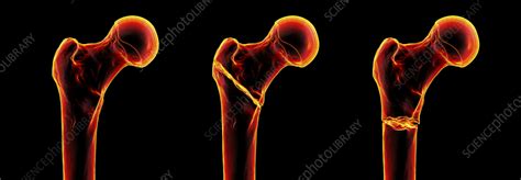 Femur Fracture Types Illustration Stock Image F043 9271 Science Photo Library