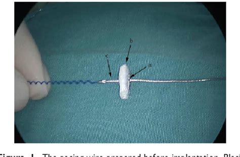 Figure 1 From Temporary Epicardial Pacing Wire Placement In Totally