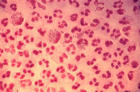 Cdc Reports A Surge In Gonorrhea Other Sexually Transmitted Diseases