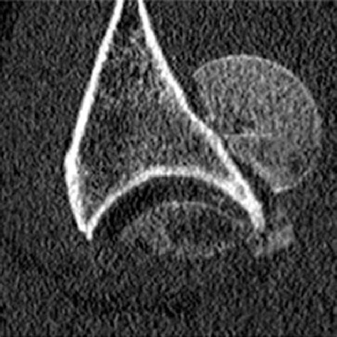 The Pipkin Classification A Type I Femoral Head Fracture Inferior