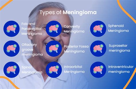 Meningioma Treatment Everything You Need To Know Actc