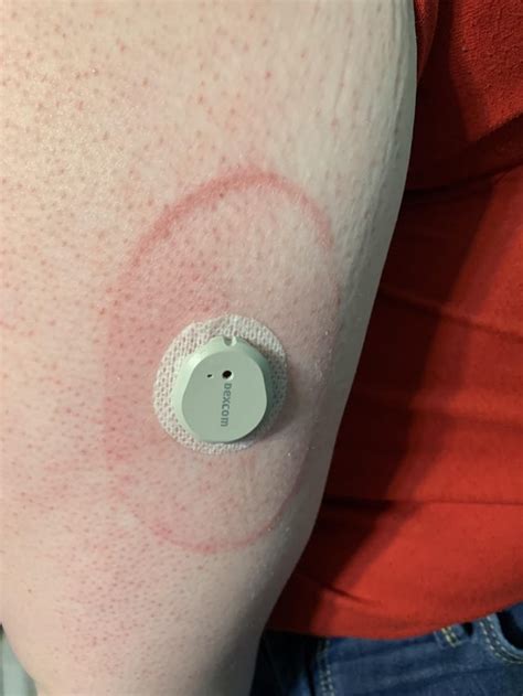 Expression Med Tape Reaction More In Comments R Dexcom