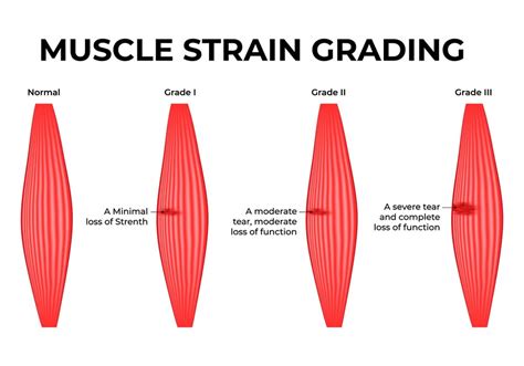 Premium Vector Muscle Strain Gradign Vector Illustration