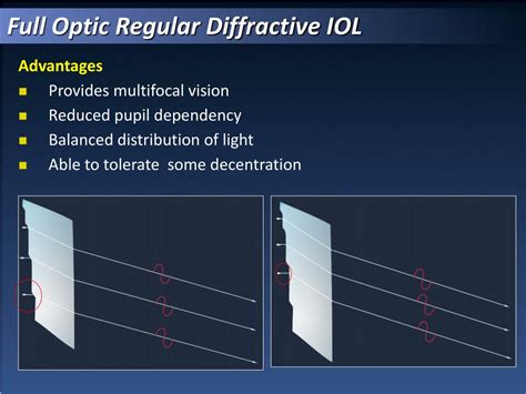 Ppt Eyediff Plus 3 50d Diffractive Multifocal Iol “a New Alternative