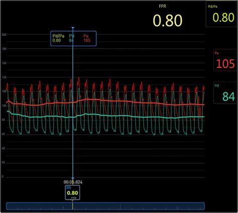 Tctap C 097 The Story Of Left Main Jacc
