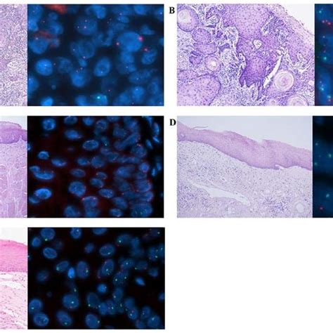 X And Y Chromosomes In Tumor Tissues Identified By Microdissection Pcr Download Scientific