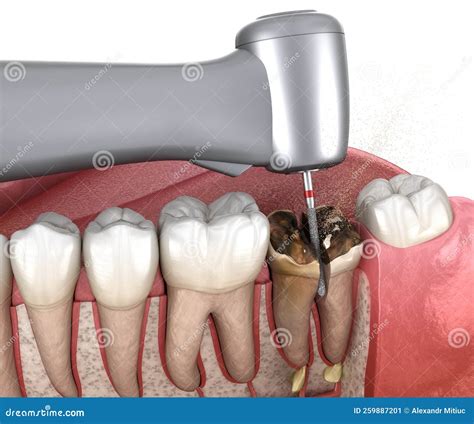 Complex Tooth Extraction Medically Accurate 3d Illustration Of Dental