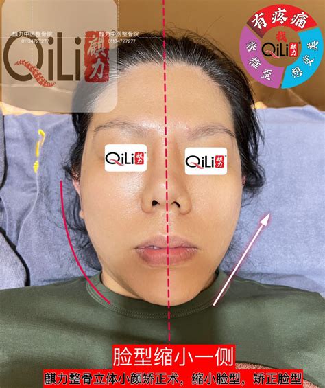 脸型缩小一侧 3d Face Make 无痛立体整骨小颜矫正20大优势 1颧骨高低矫正 2颧骨 缩小 3下颌骨 缩小 4眉骨