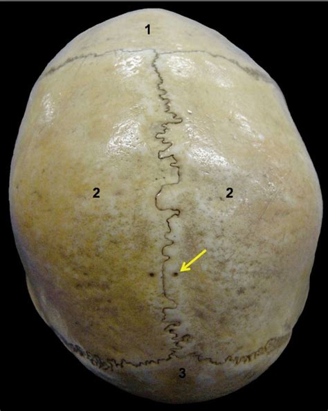 Forámenes Emisarios Del Cráneo Humano Características Anatómicas Y Sus