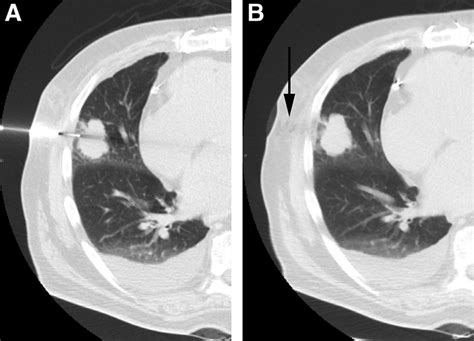 Biopsy Ct A Intraprocedure Axial Ct Scan Demonstrating Trocar Download Scientific Diagram