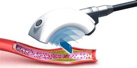 Urology Eswt Ed Elvation Medical