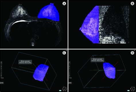 MRI Based Three Dimen Sional 3D Reconstructed Breast Image Using An
