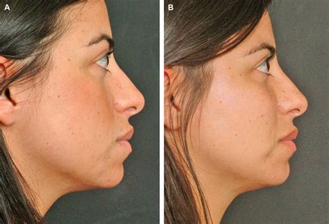 Autologous Fat Grafting For Cosmetic Enhancement Of The Perioral Region