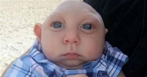 ClÍnica De Logopedia Y Apoyo Escolar ¿quÉ Es La Microcefalia