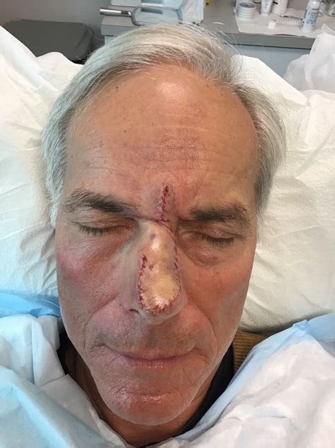 Dorsal Nasal Rotation Flap Acms American College Of Mohs Surgery