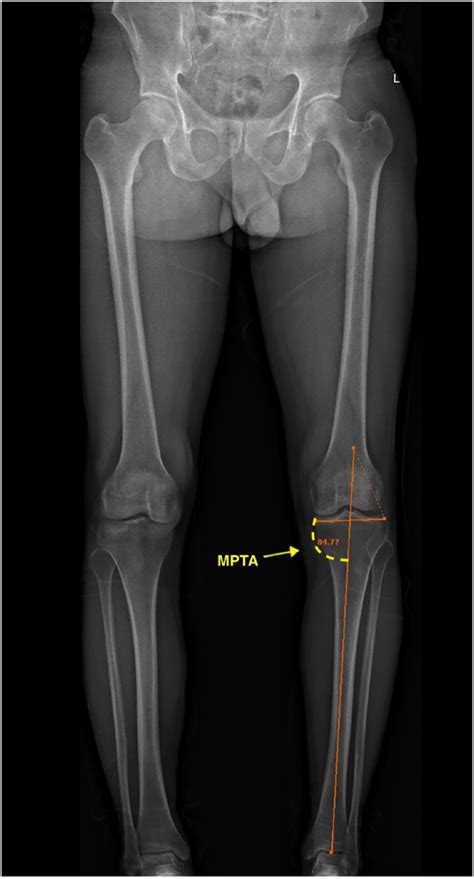 Medial Proximal Tibial Angle MPTA The Proximal Medial Angle Formed