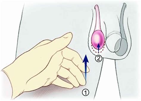 Cremasteric Reflex Definition And Cremasteric Reflex Test