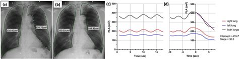 Projected Lung Area Using Dynamic X Ray Dxr With A Flat Panel Detector System And Automated